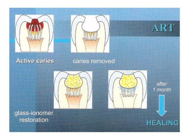 Atraumatic Restorative Treatment ART