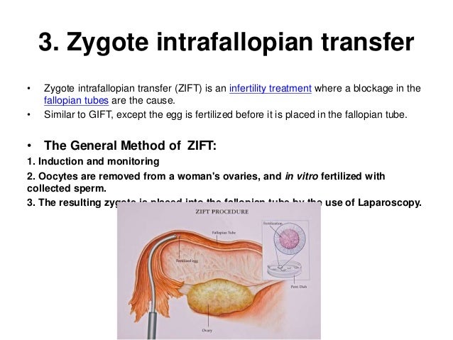 Zygote Intrafallopian Transfer Zygote Intrafallopian Transfer ...