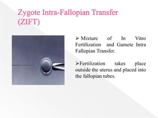 Assisted Reproductive Technology | PPTX