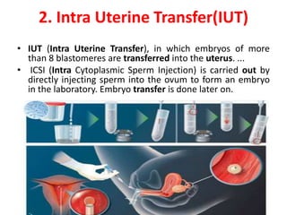 Assisted Reproductive technology (ART) | PPTX