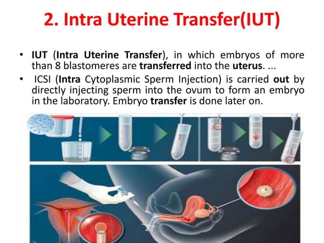 Assisted Reproductive technology (ART) | PPTX