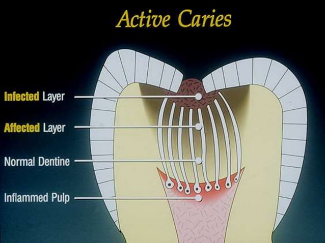 Atrumatic Restorative Treatment.ppt | Dental Health | Diseases and ...
