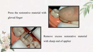ART - Atraumatic Restorative Treatment.pptx