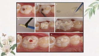 ART - Atraumatic Restorative Treatment.pptx