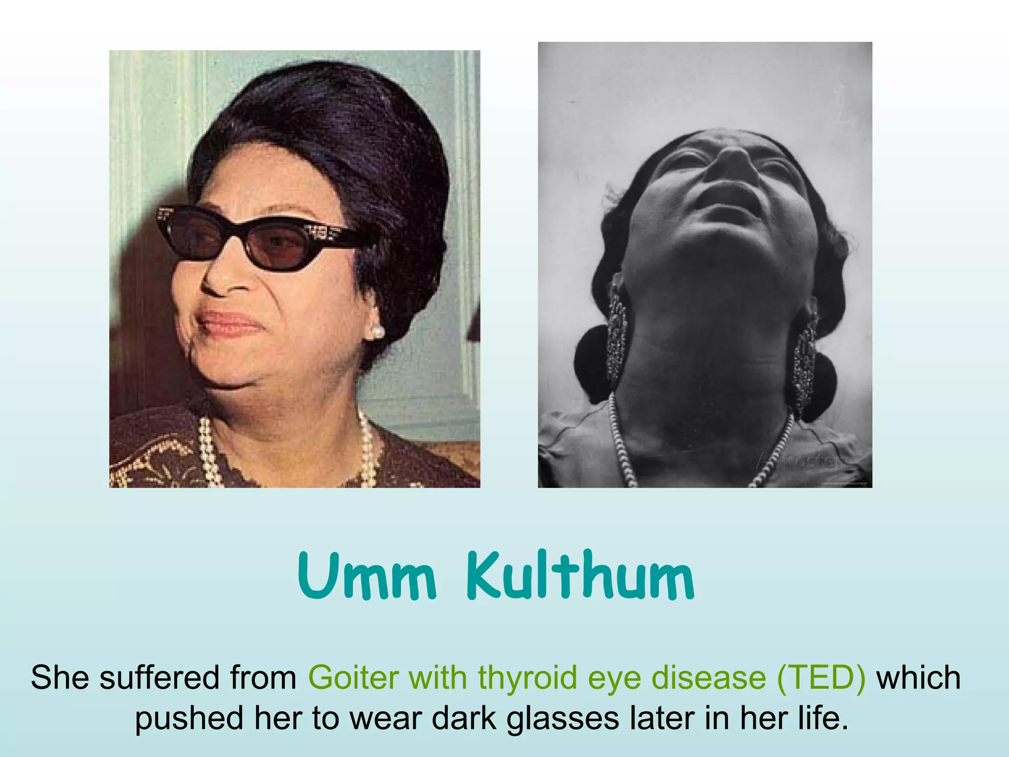 Famous Eye Patients ! | PPT