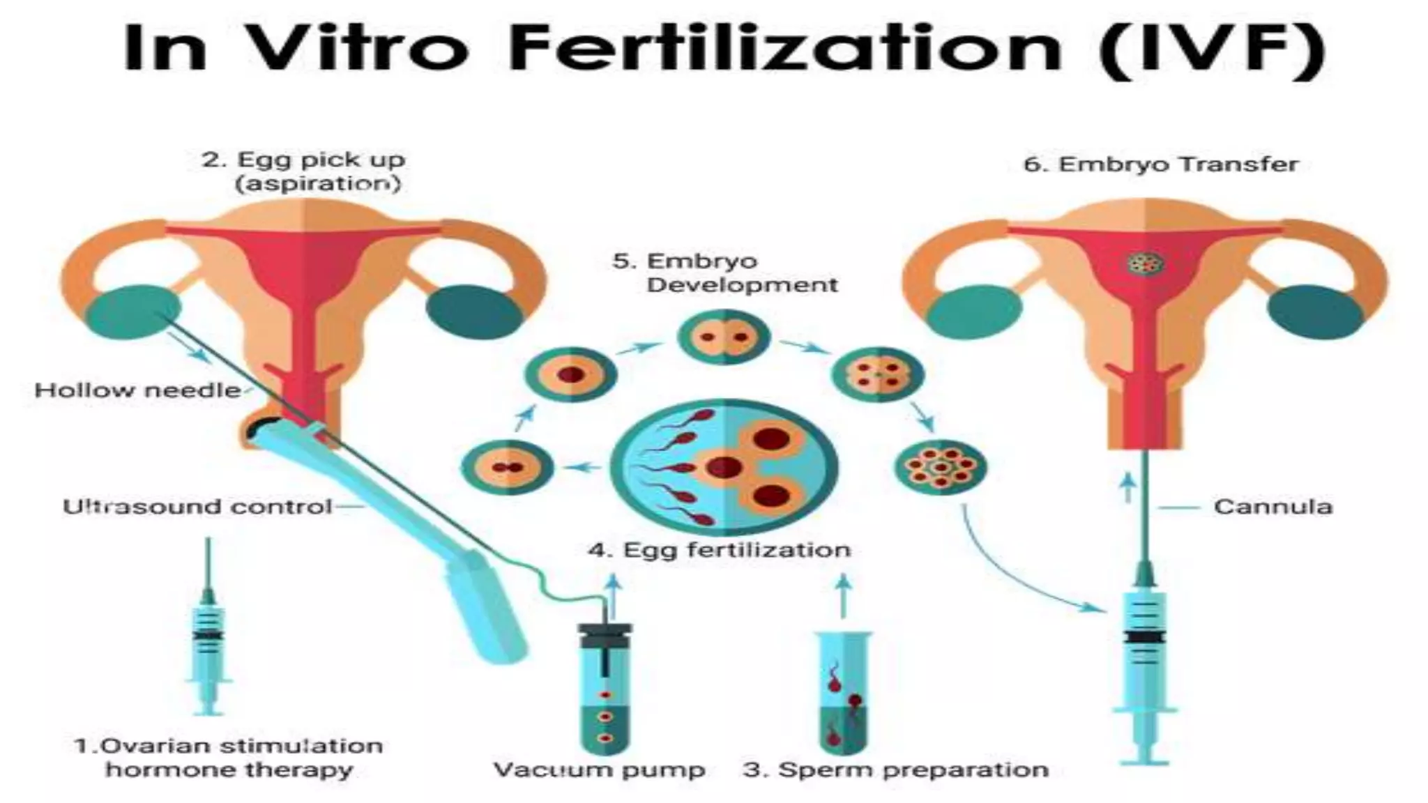 The Assisted Reproductive Techniques - ART (IVF, IUI, ZIFT, GIFT, ICSI etc.) | PPTX