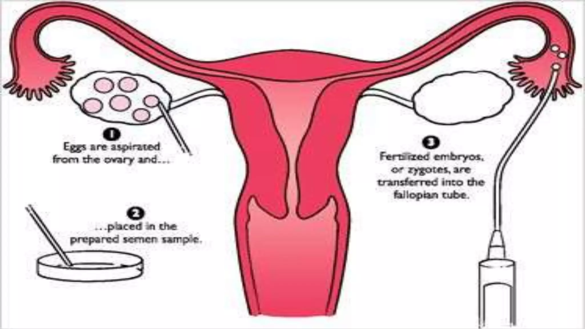 The Assisted Reproductive Techniques - ART (IVF, IUI, ZIFT, GIFT, ICSI etc.) | PPTX