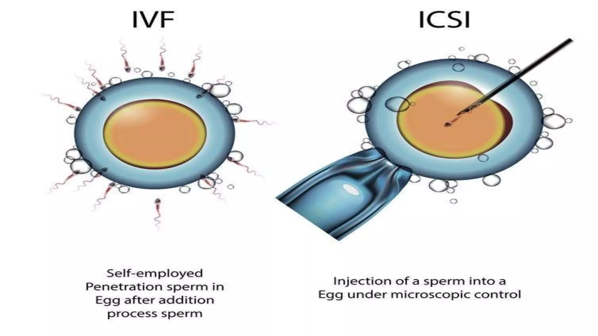 The Assisted Reproductive Techniques - ART (IVF, IUI, ZIFT, GIFT, ICSI etc.) | PPTX