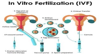The Assisted Reproductive Techniques - ART (IVF, IUI, ZIFT, GIFT, ICSI etc.) | PPT