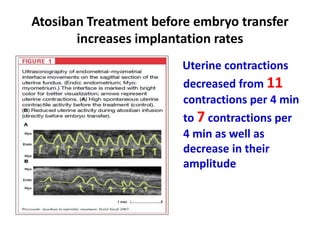 Role of Atosiban In ART 2018 Dr Jyoti Agarwal | PPTX