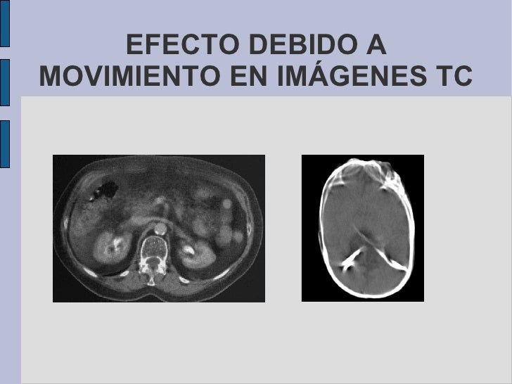 Artefactos En Tomografia Computadorizada