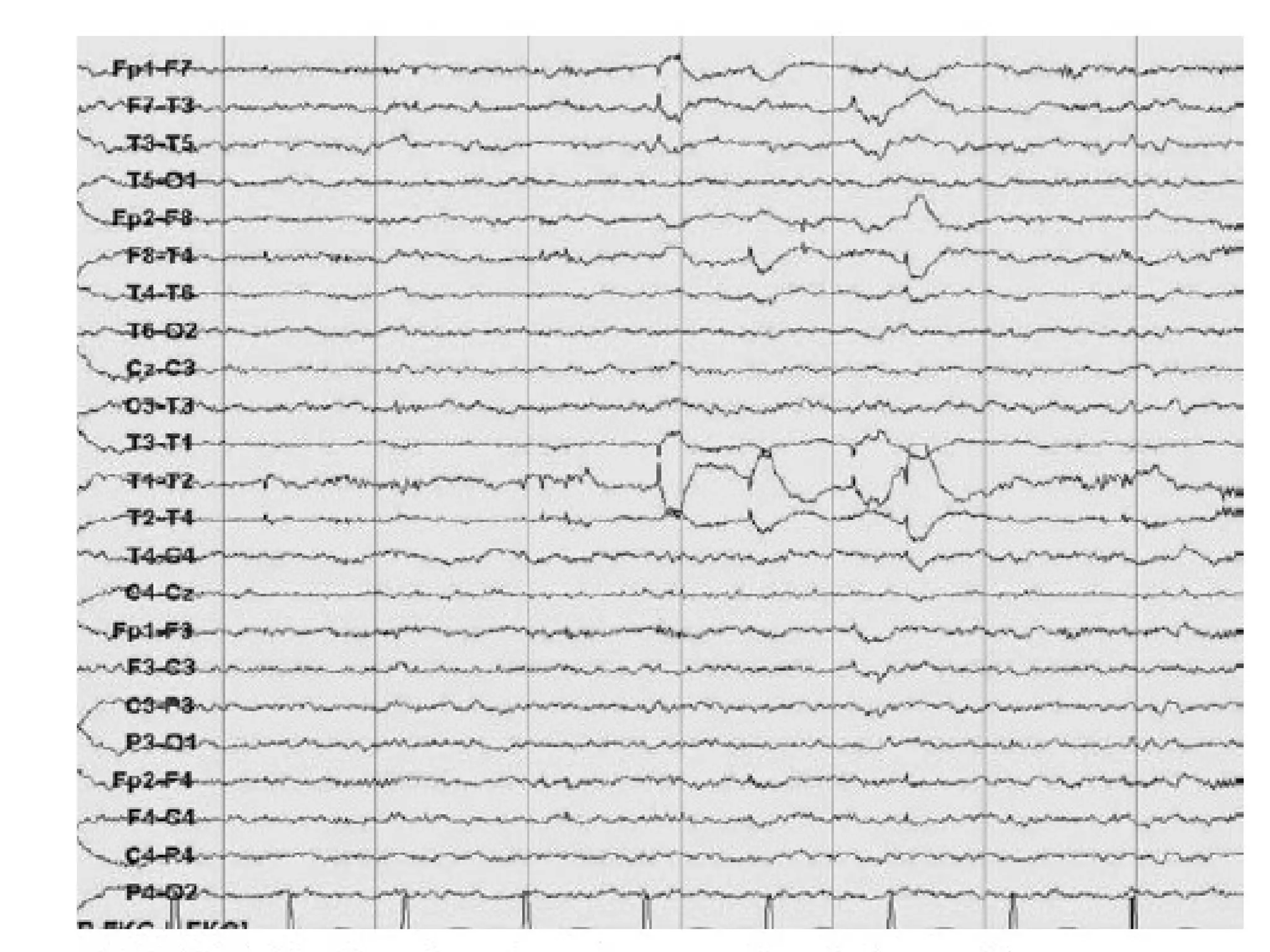 Artifacts in EEG - Recognition and differentiation | PPT