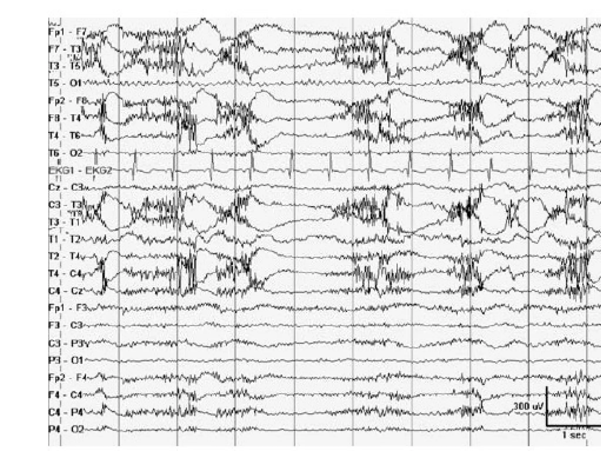 Artifacts in EEG - Recognition and differentiation | PPT