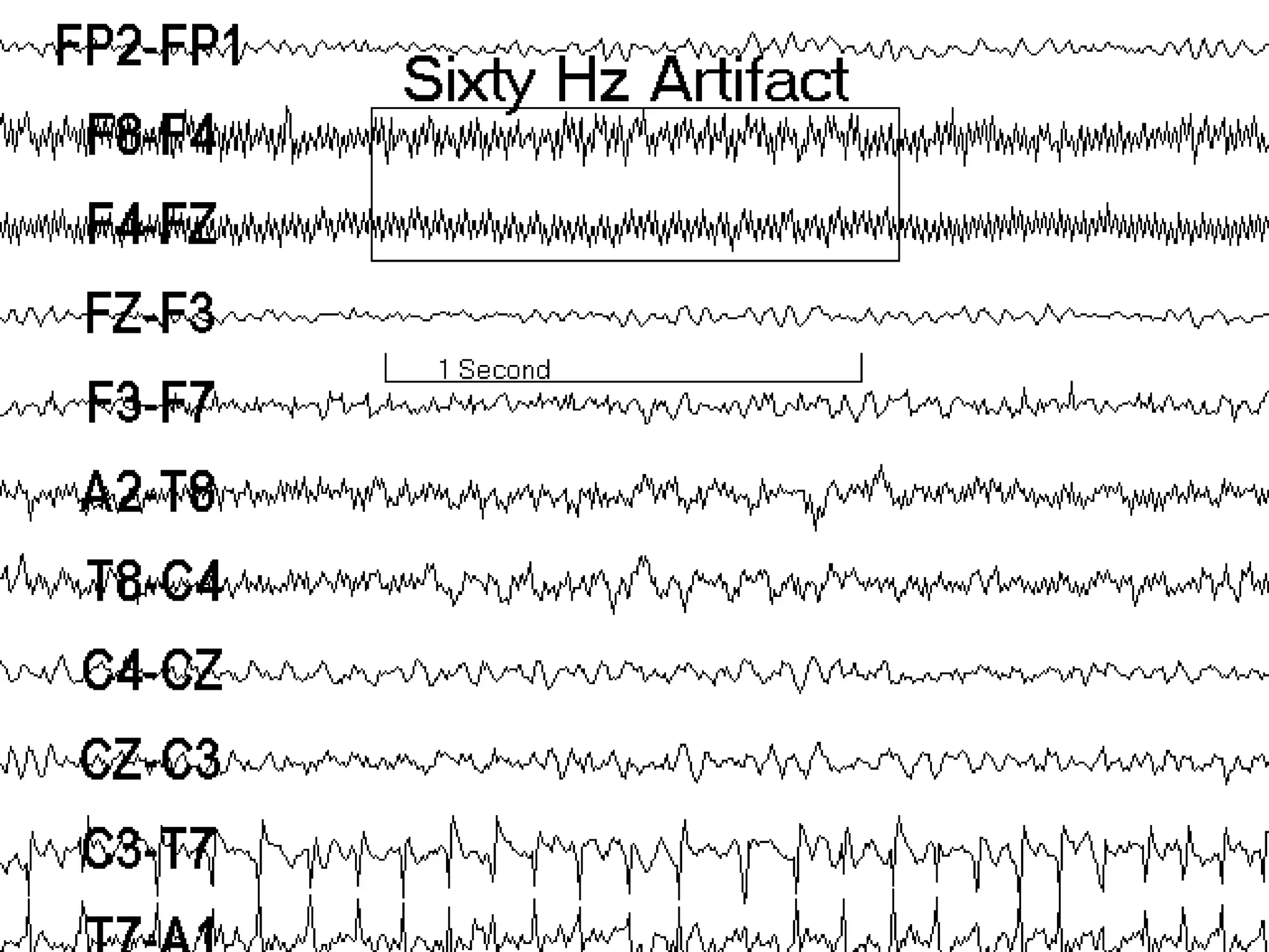 Artifacts in EEG - Recognition and differentiation | PPT