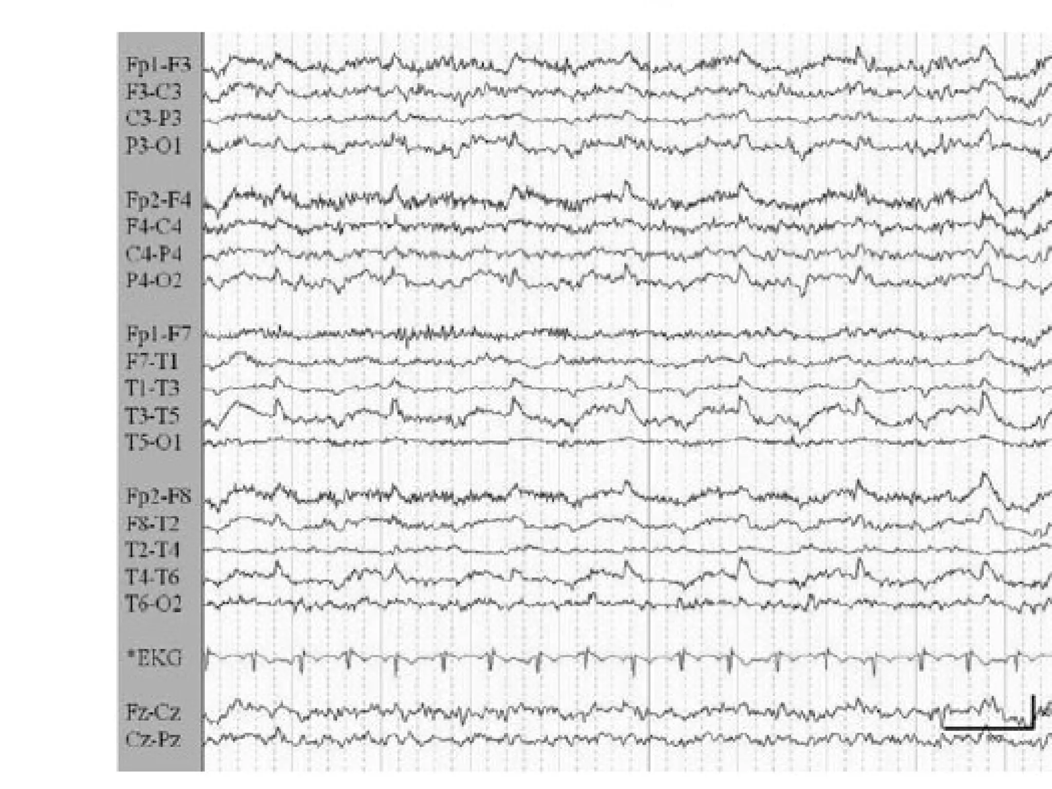 Artifacts in EEG - Recognition and differentiation | PPT