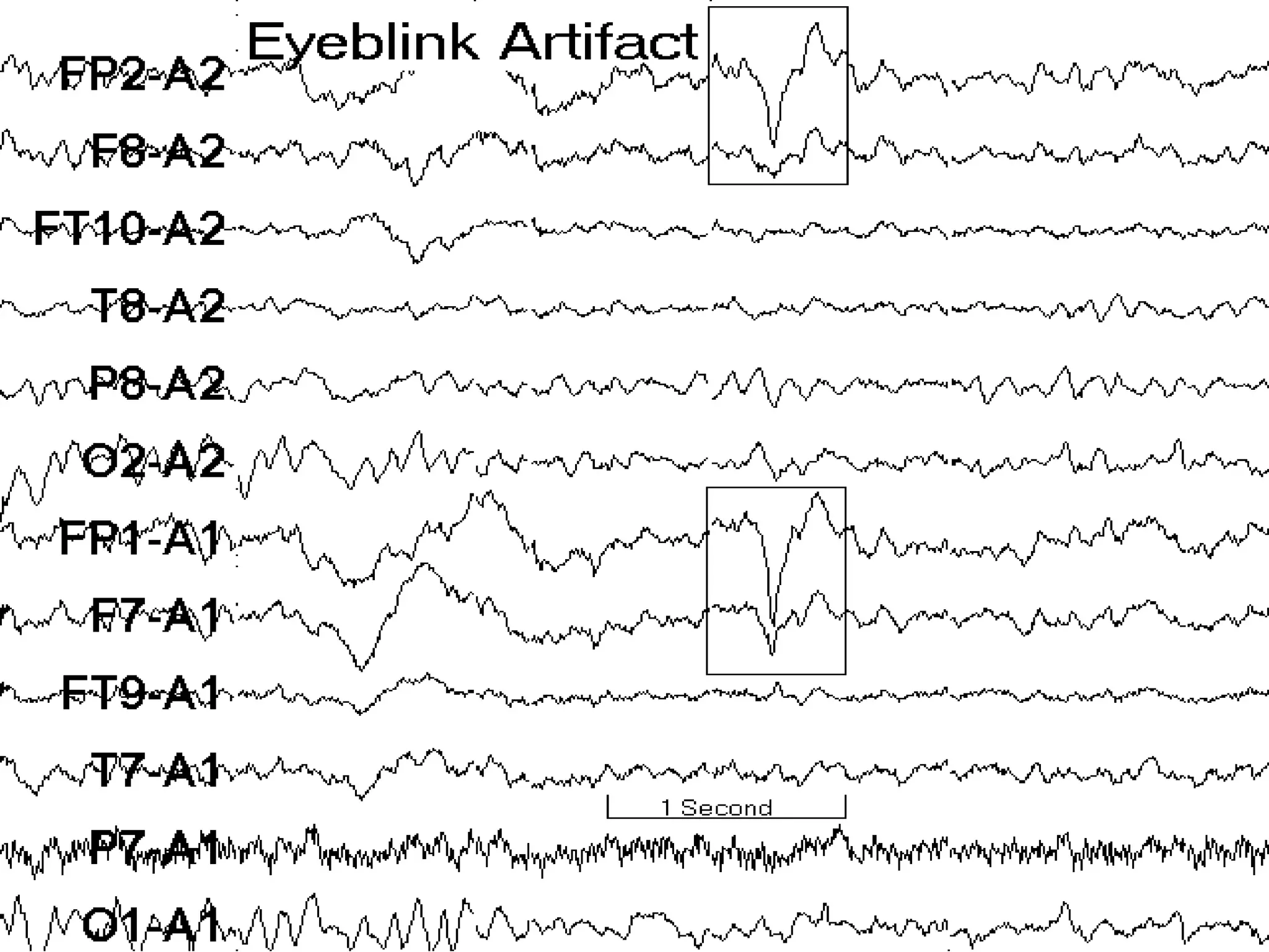 Artifacts in EEG - Recognition and differentiation | PPT