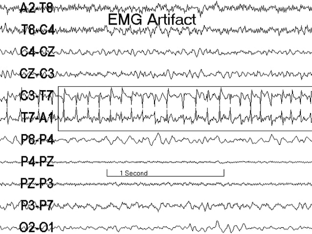 Artifacts in EEG - Recognition and differentiation | PPT
