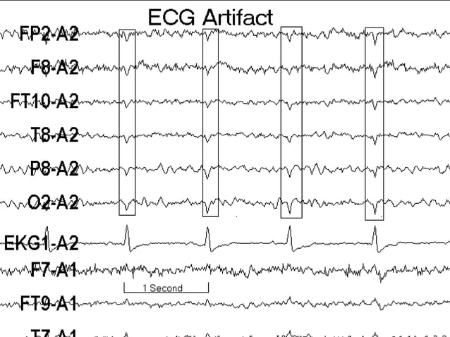 Artifacts in EEG - Recognition and differentiation | PPT