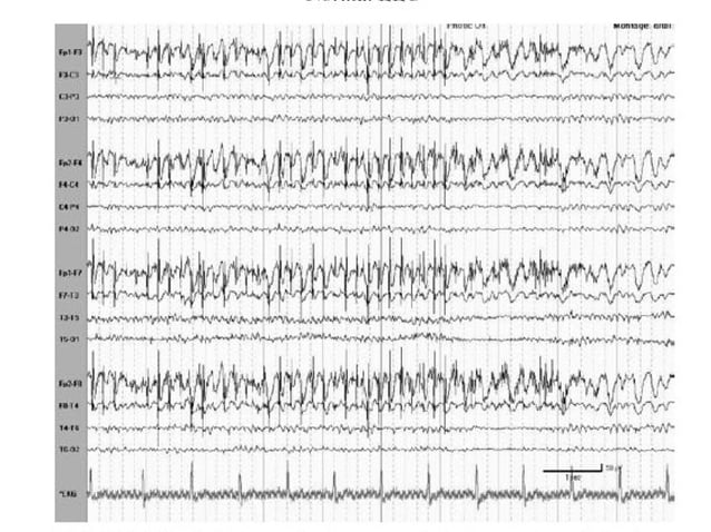 Artifacts in EEG - Recognition and differentiation | PPT