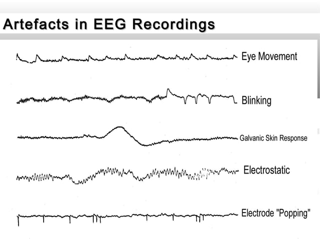 Artifacts in EEG - Recognition and differentiation | PPT