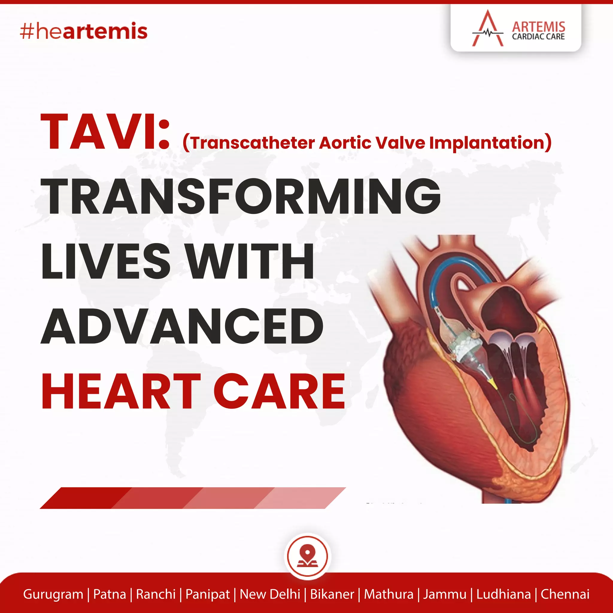 Revolutionizing Heart Care: Transcatheter Aortic Valve Implantation ...