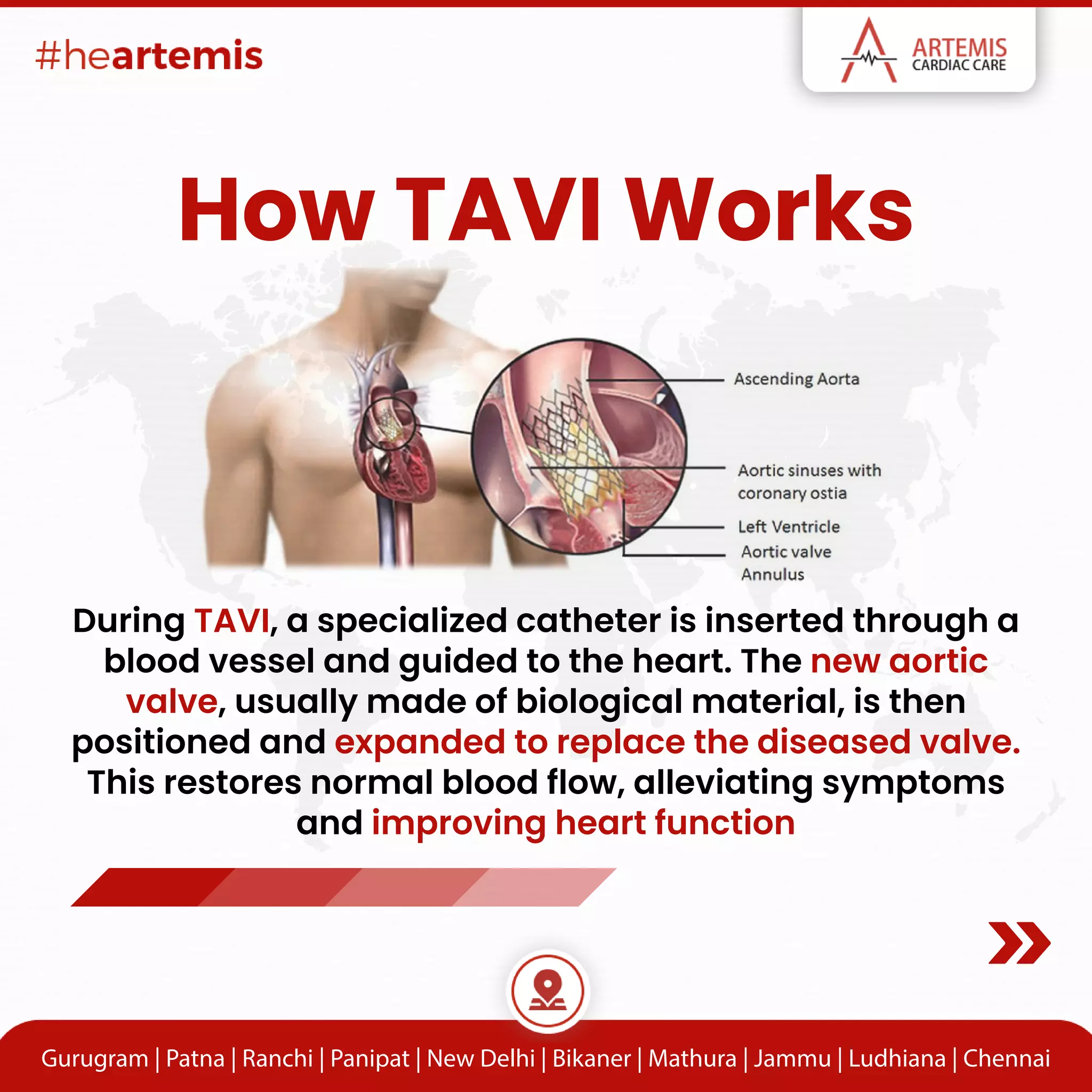 Revolutionizing Heart Care: Transcatheter Aortic Valve Implantation ...