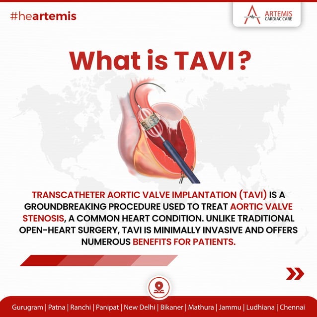 Revolutionizing Heart Care: Transcatheter Aortic Valve Implantation ...
