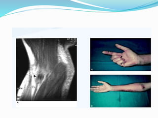 Arterial access of the upper limb | PPTX