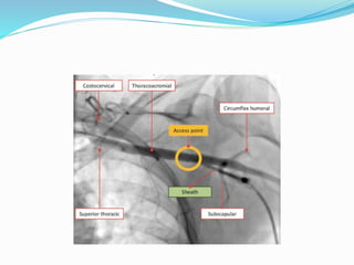 Arterial access of the upper limb | PPTX