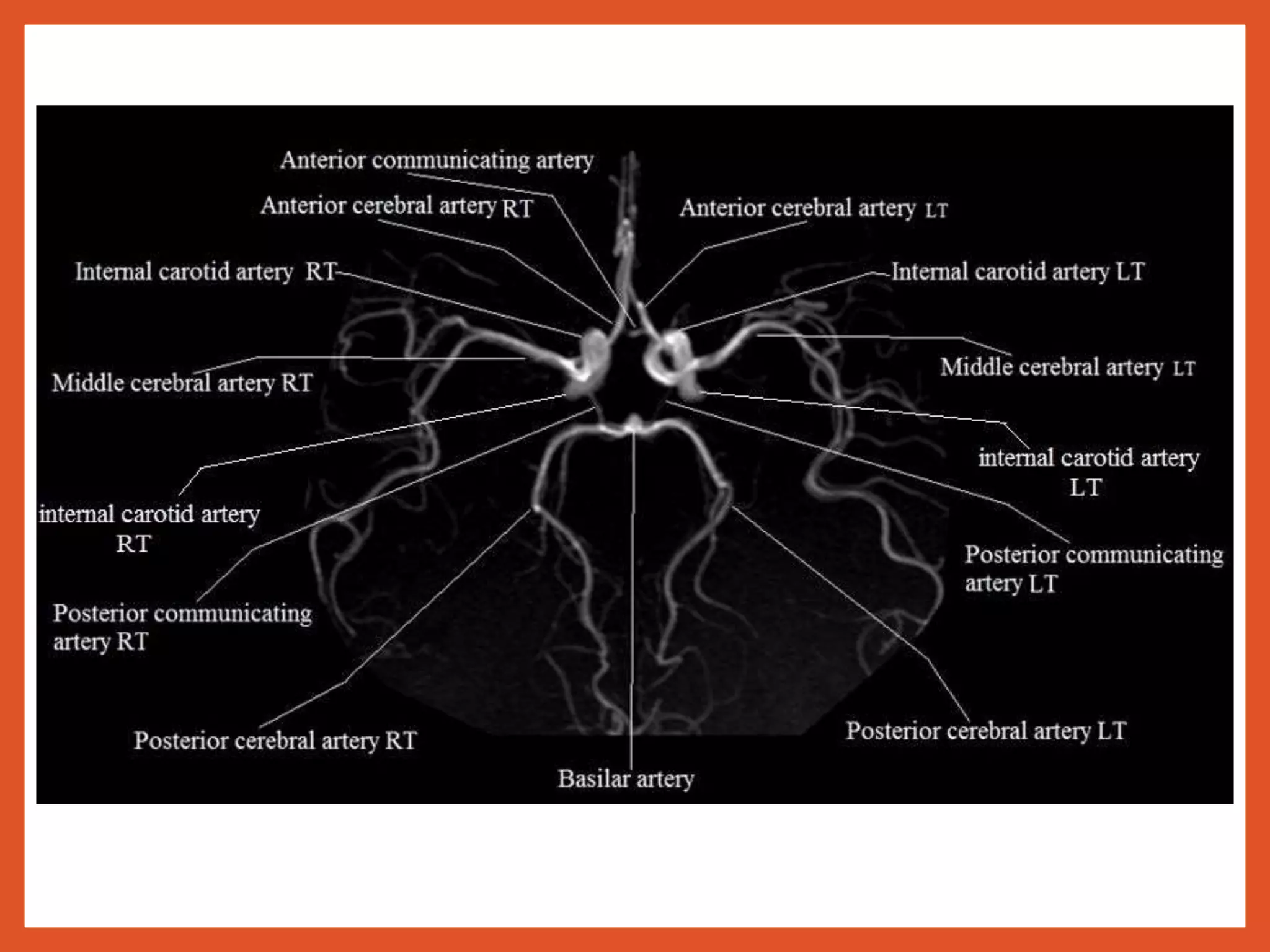 Arterial anatomy of Brain | PPTX