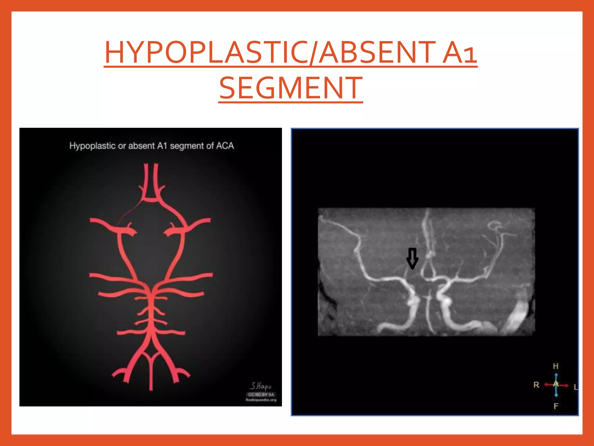 Arterial anatomy of Brain | PPTX