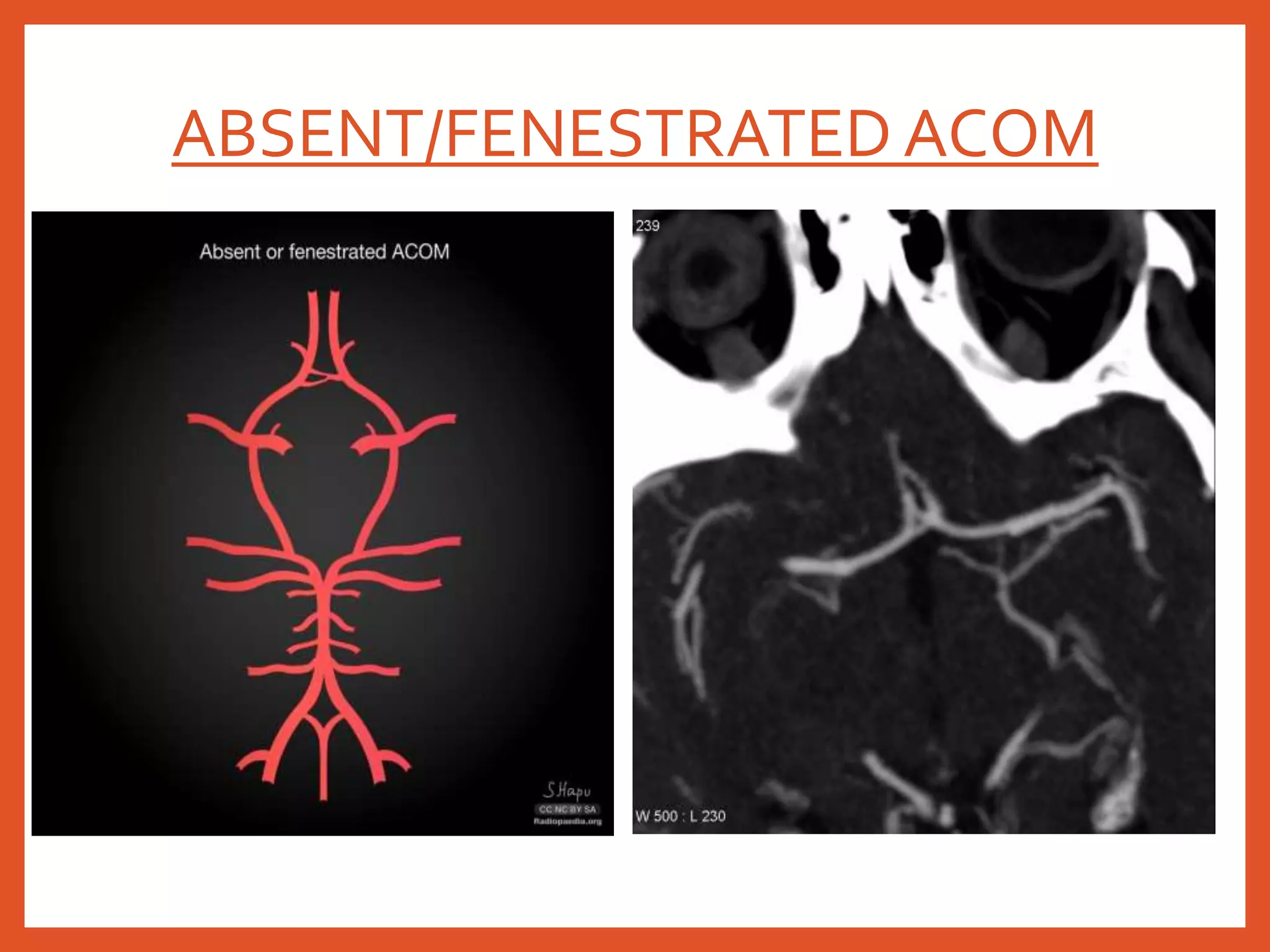 Arterial anatomy of Brain | PPTX