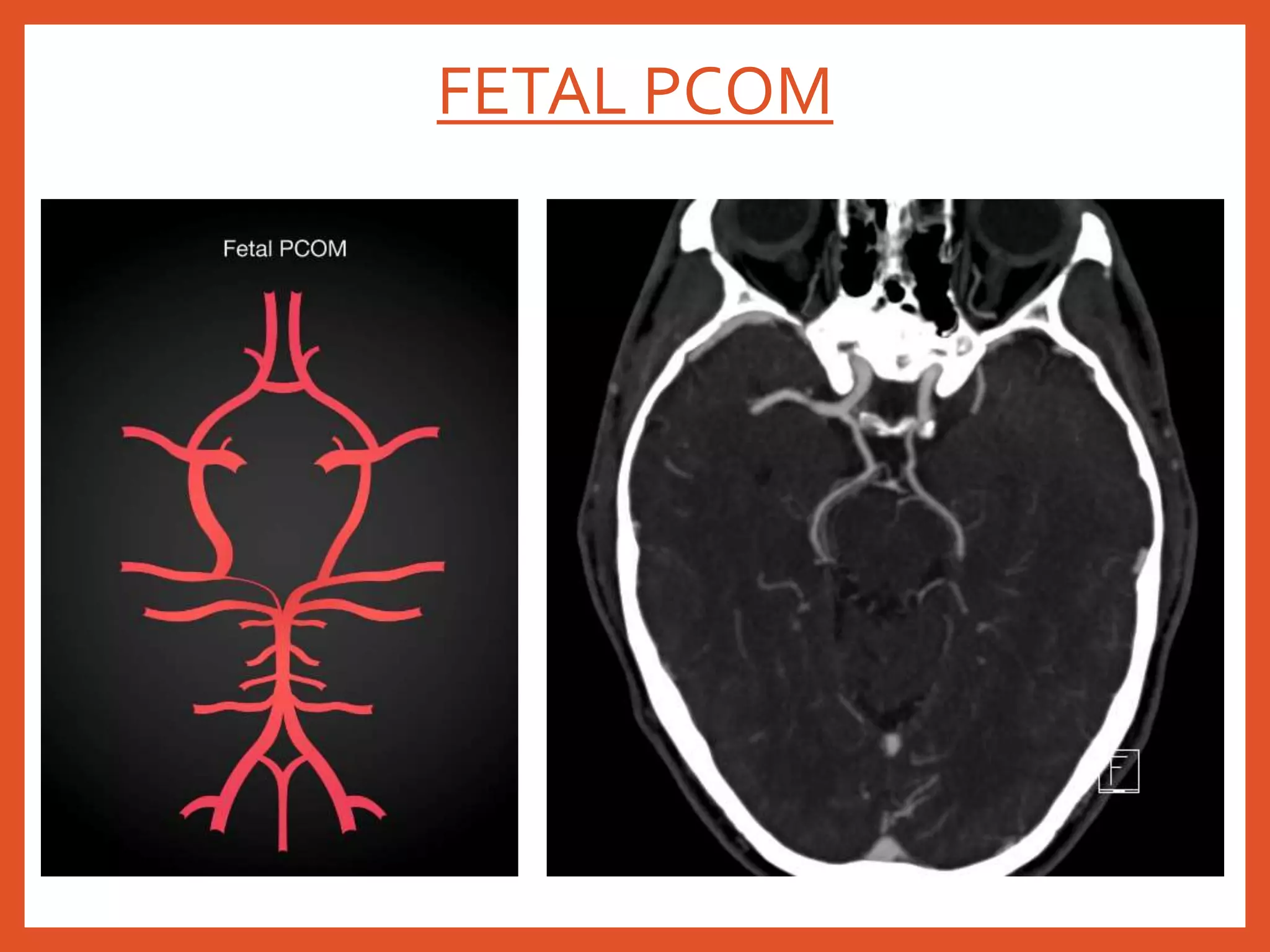 Arterial anatomy of Brain | PPTX