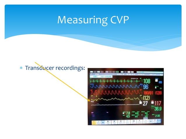 Arterial_and_CVP_monitoring.ppt | Heart and Cardiovascular Diseases ...