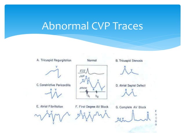 Arterial_and_CVP_monitoring.ppt | Heart and Cardiovascular Diseases | Diseases and Conditions