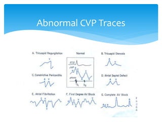 Abnormal Cvp Waveform