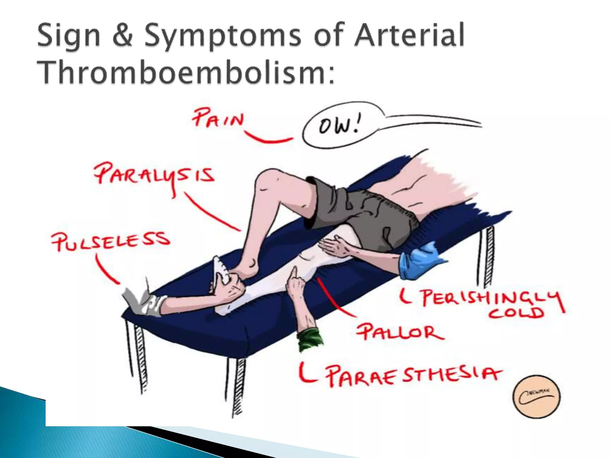 Arterial and venous embolectomy | PPTX