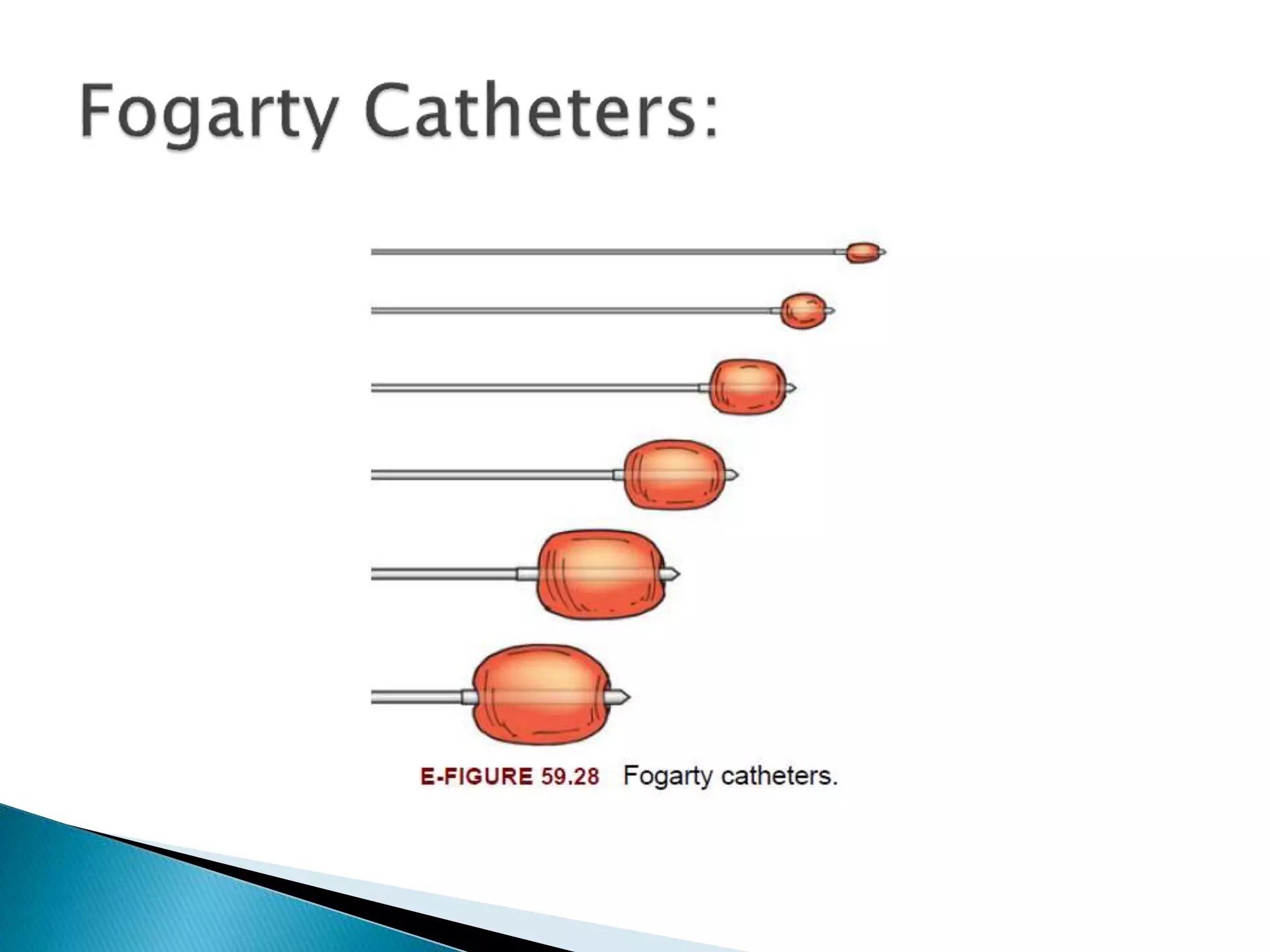 Arterial and venous embolectomy | PPTX