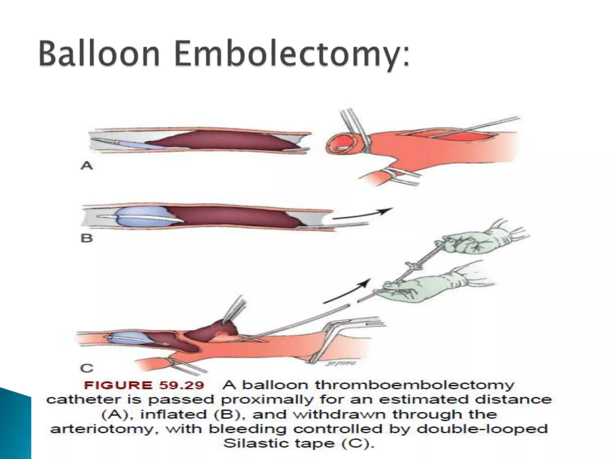 Arterial and venous embolectomy | PPTX