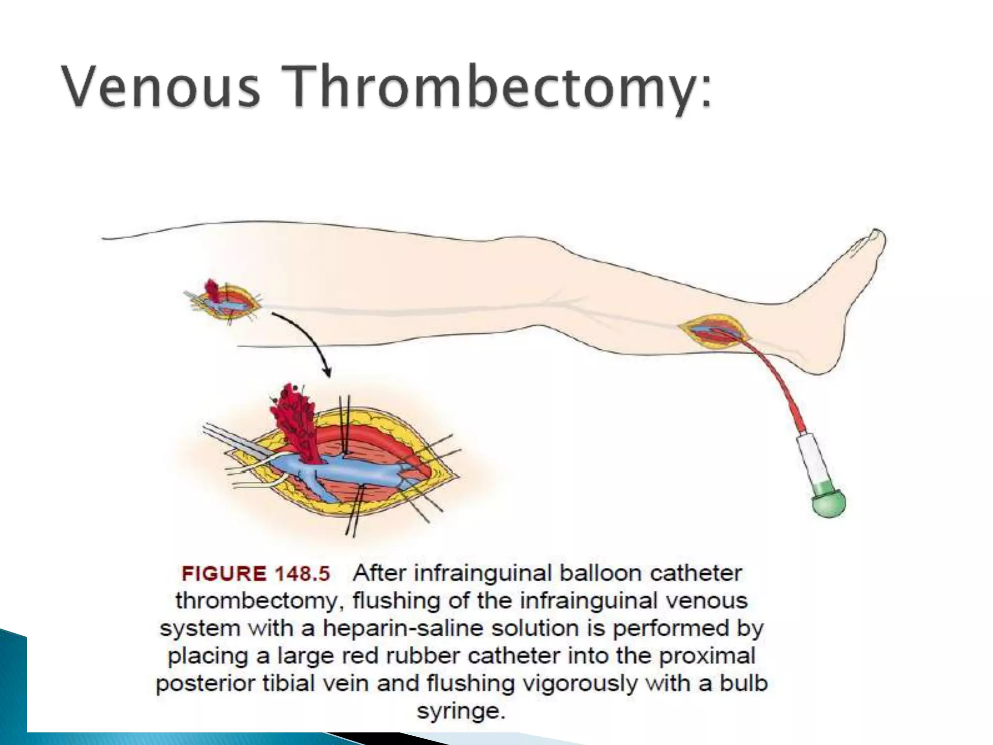 Arterial and venous embolectomy | PPTX