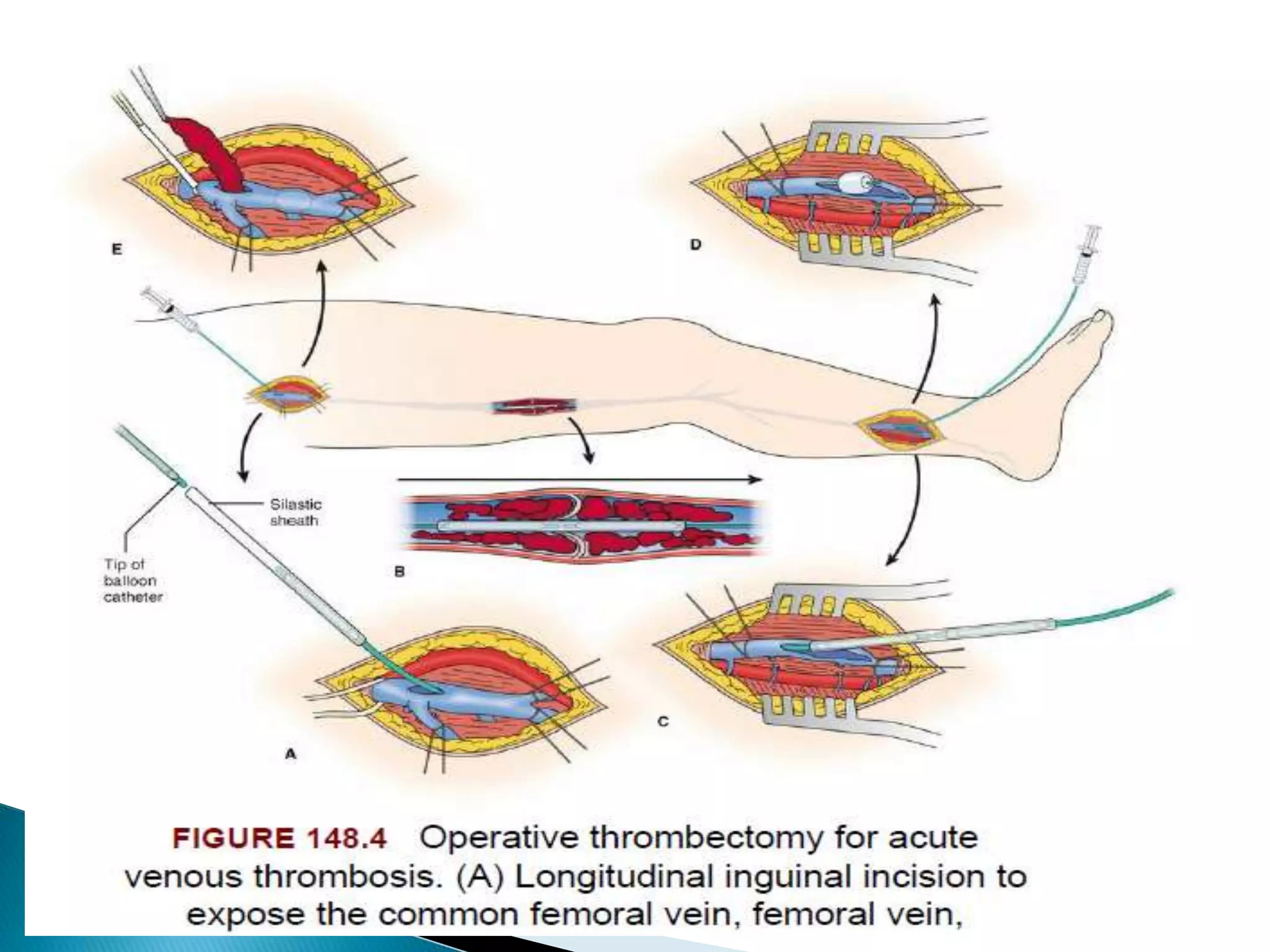 Arterial and venous embolectomy | PPTX