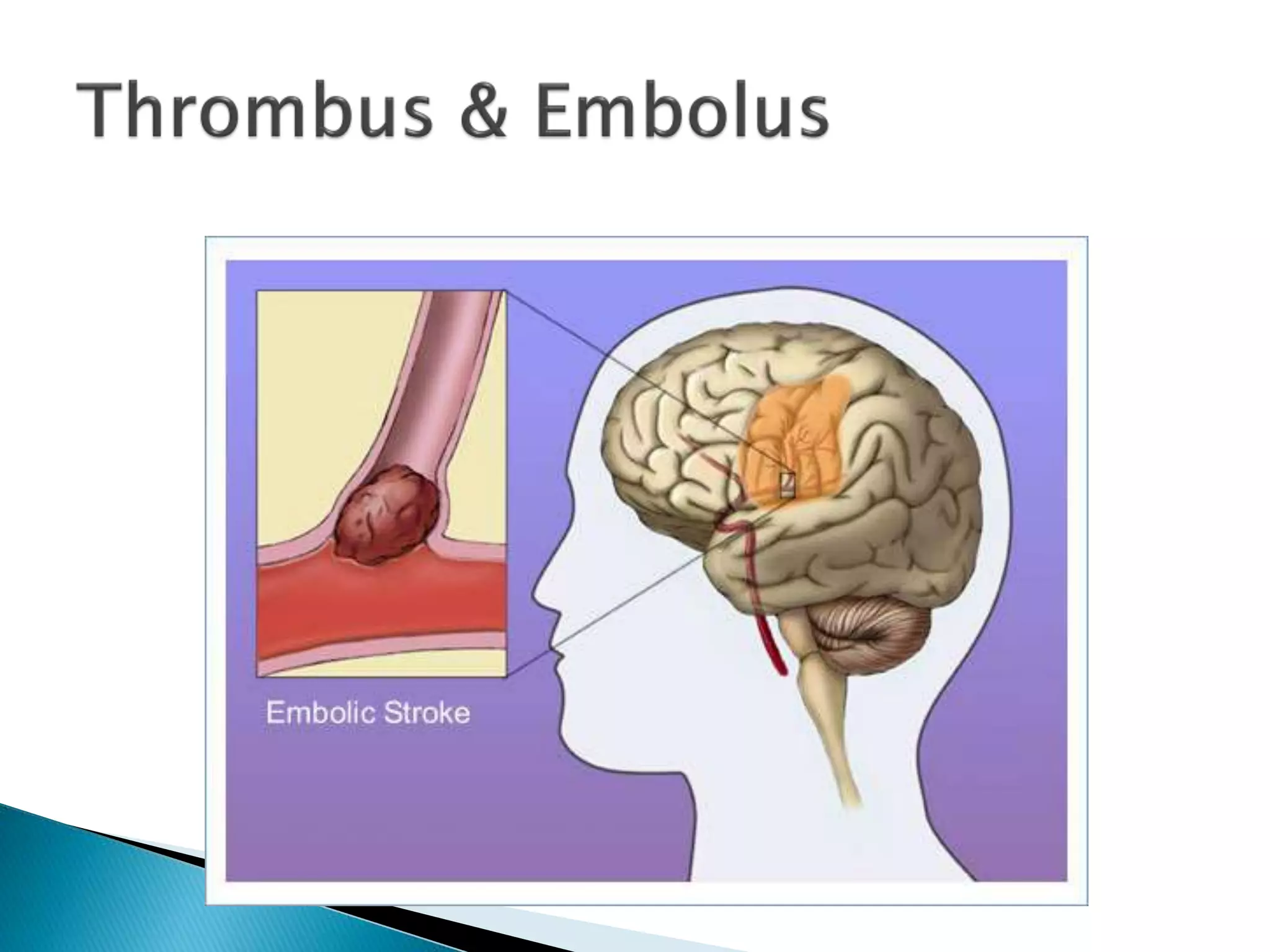 Arterial and venous embolectomy | PPTX