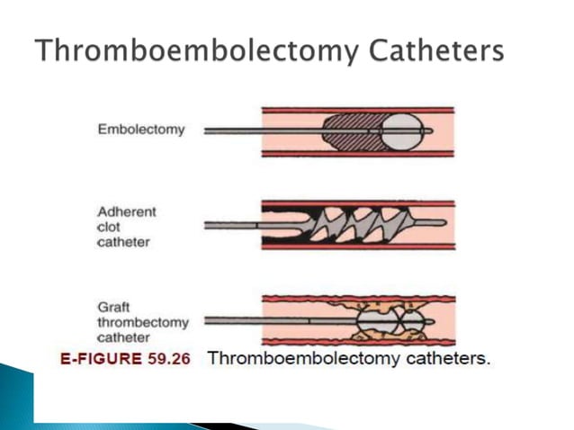 Arterial and venous embolectomy | PPTX | Blood Disorders | Diseases and ...