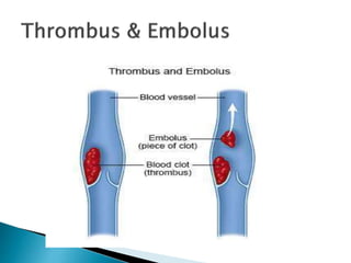 Arterial and venous embolectomy | PPTX