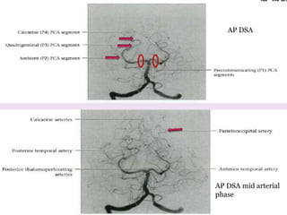 Arterial and venous supply of brain part2 | PPTX