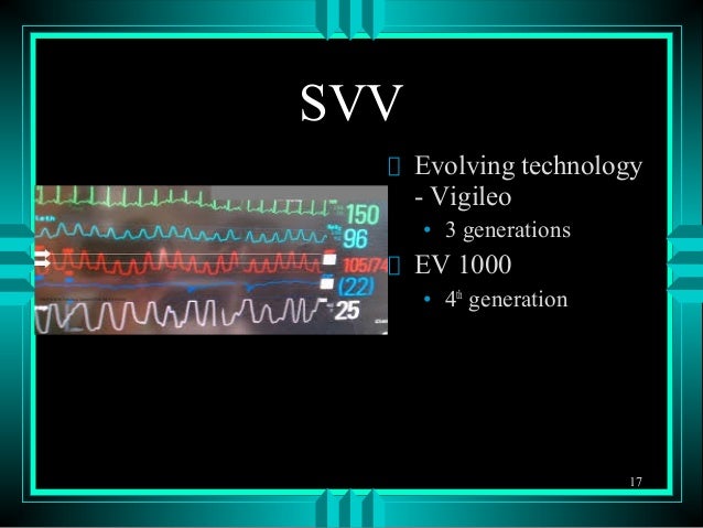 Using Arterial Pressure Based Cardiac Output to Guide Therapy - Chris…