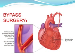 Arterial clearance therapy(act). EECP THERAPY | PPT