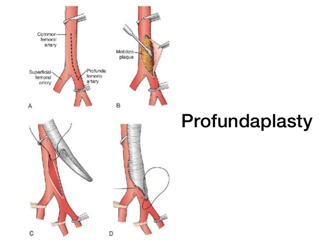 Arterial disease
