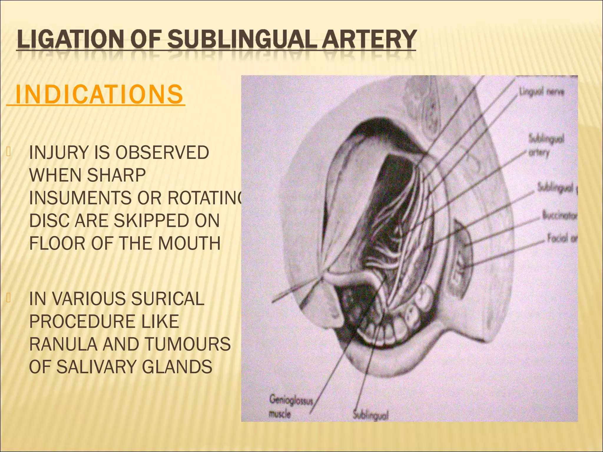 VESSEL ligation | PPT