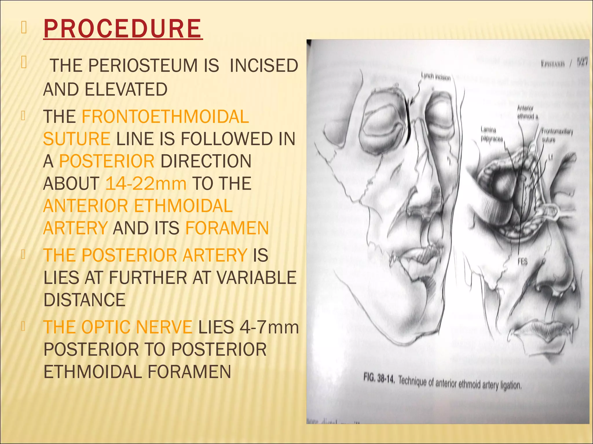 VESSEL ligation | PPT